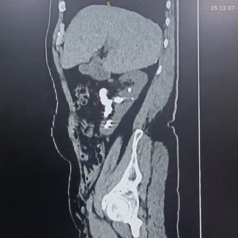 A Kidney Stone That Exhausted a Patient for Years—Precisely Resolved by ...